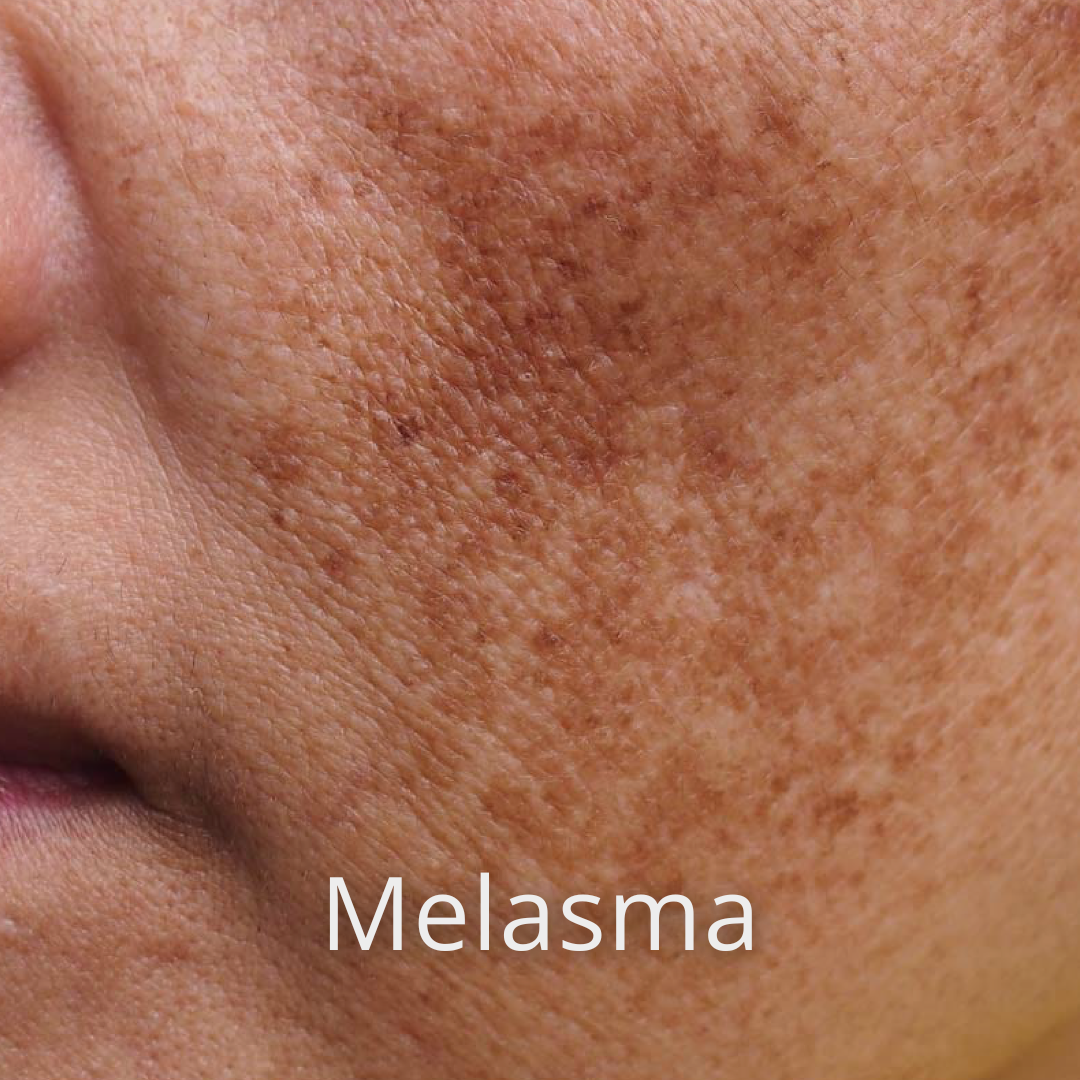 Melasma Treatment Kits for Dark Patches & Uneven Skin Tone | Aloe&Me ...